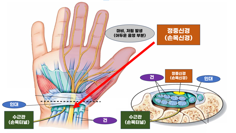 간호조무사 성인간호 수근관 증후군
